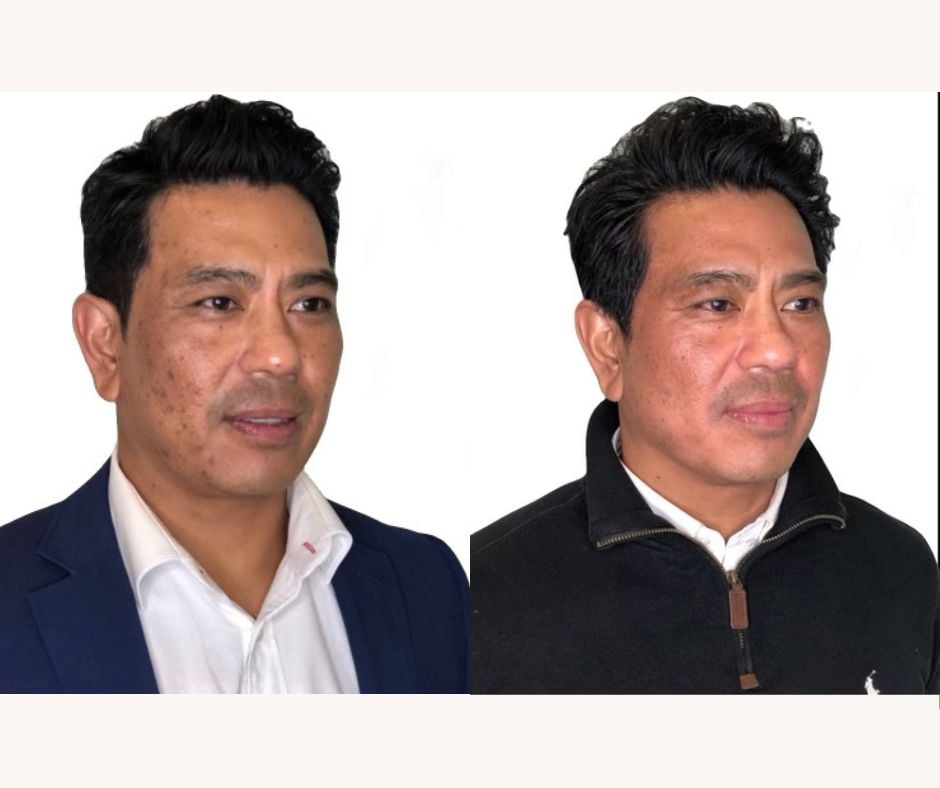 Depigmentation — Sanctuary Cosmetic Clinics